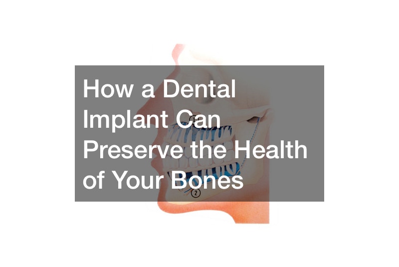 How a Dental Implant Can Preserve the Health of Your Bones